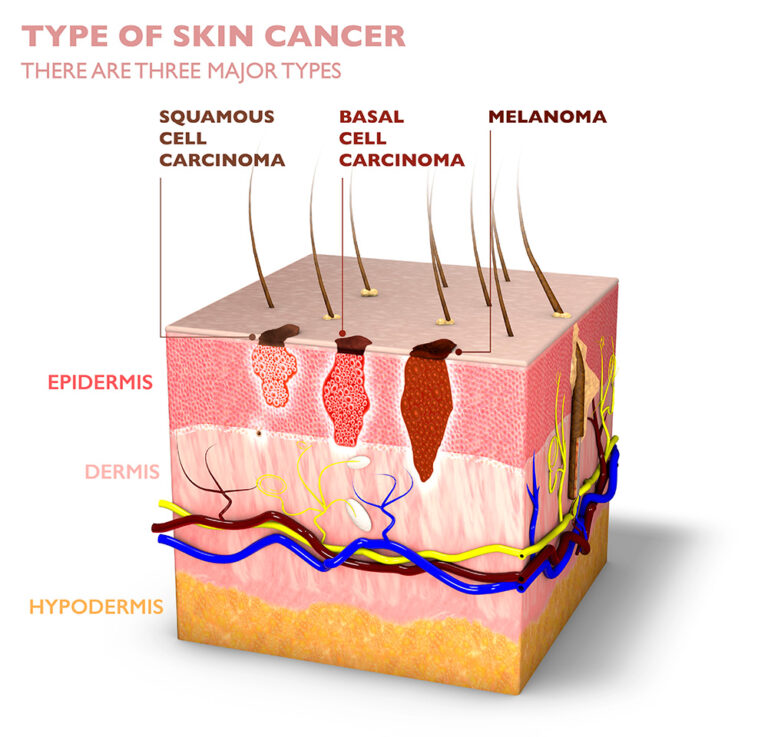 Skin Cancer Checks & Treatment in Perth | The Woods Medical Centre